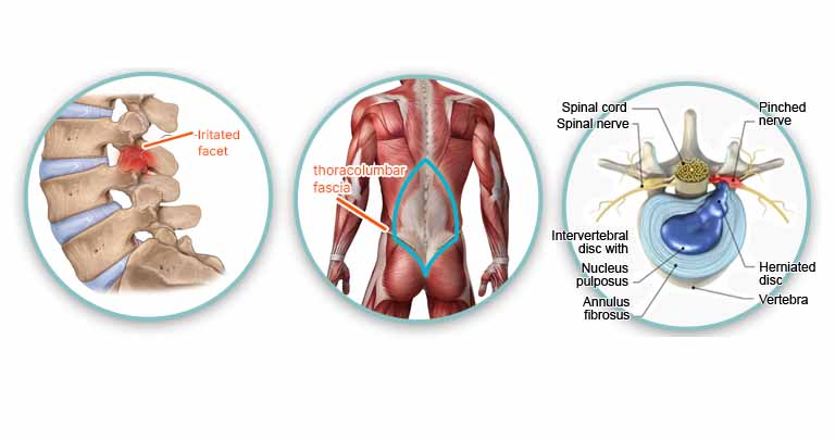 The END of Back Pain?